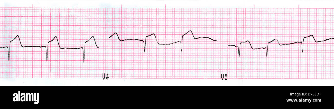 Heart Attack Ecg High Resolution Stock Photography and Images - Alamy