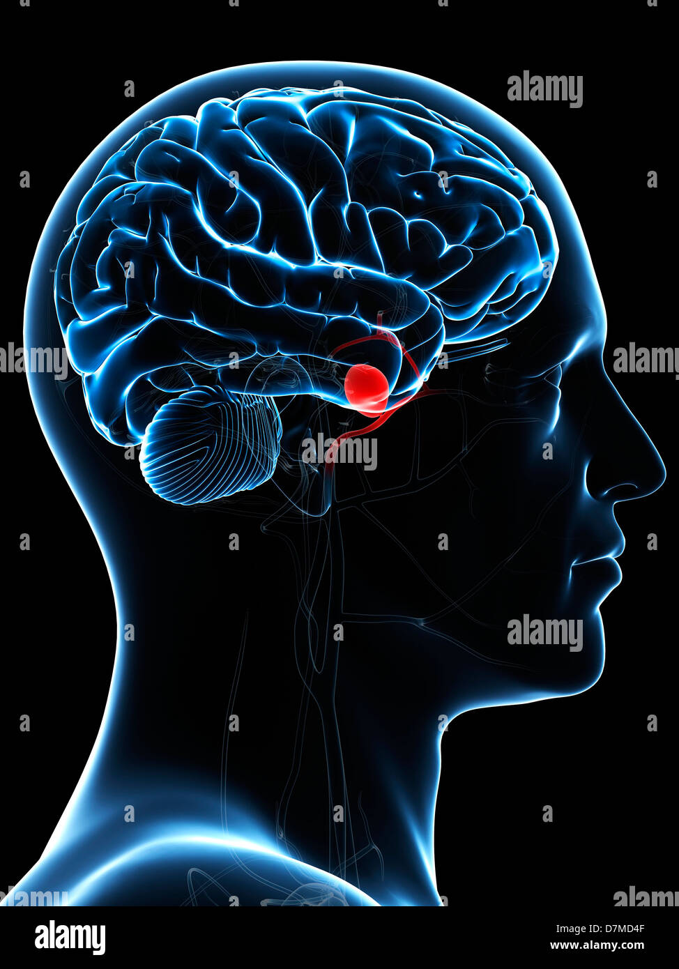 Brain aneurysm, artwork Stock Photo - Alamy Brain aneurysm, artwork Stock Photo - Alamy