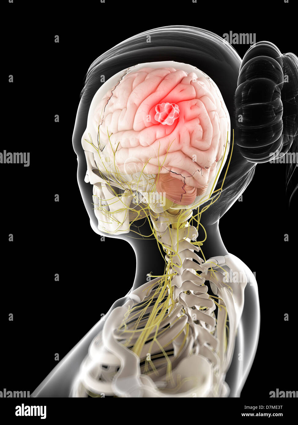 Female brain cancer hi-res stock photography and images - Alamy