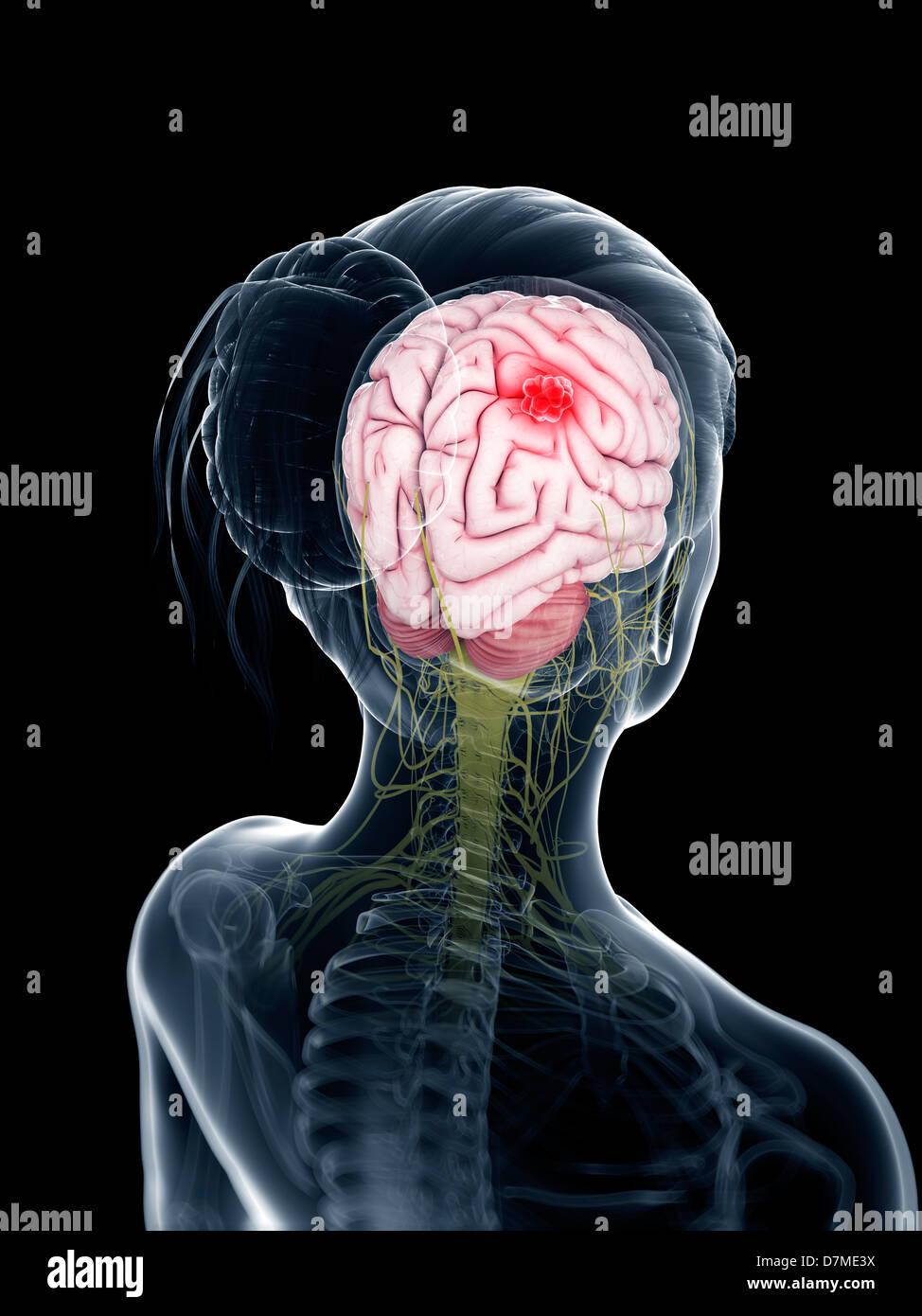 Female brain cancer hi-res stock photography and images - Alamy