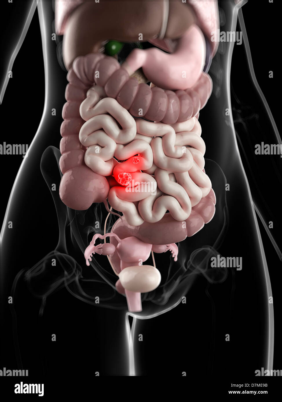 Intestinal cancer, artwork Stock Photo - Alamy