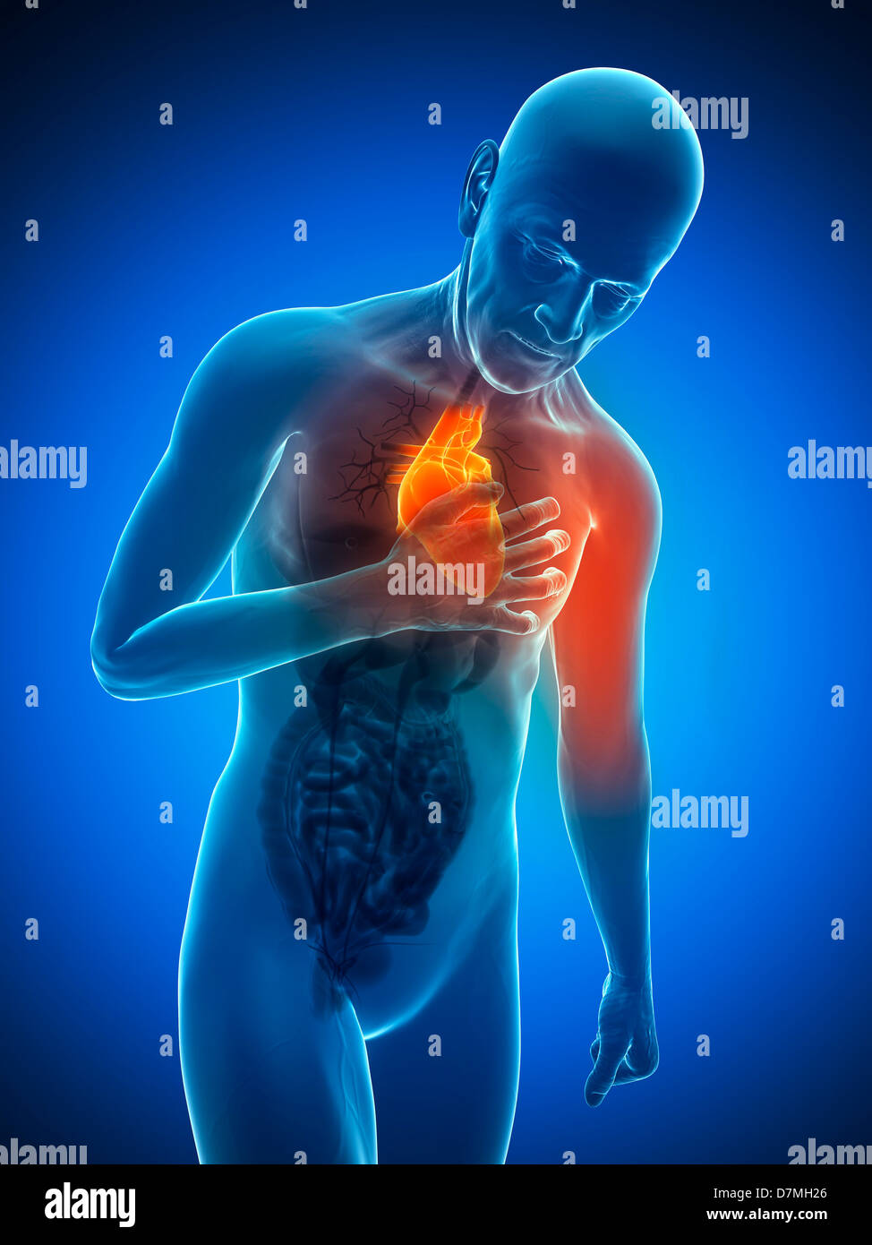 Heart attack, artwork Stock Photo - Alamy