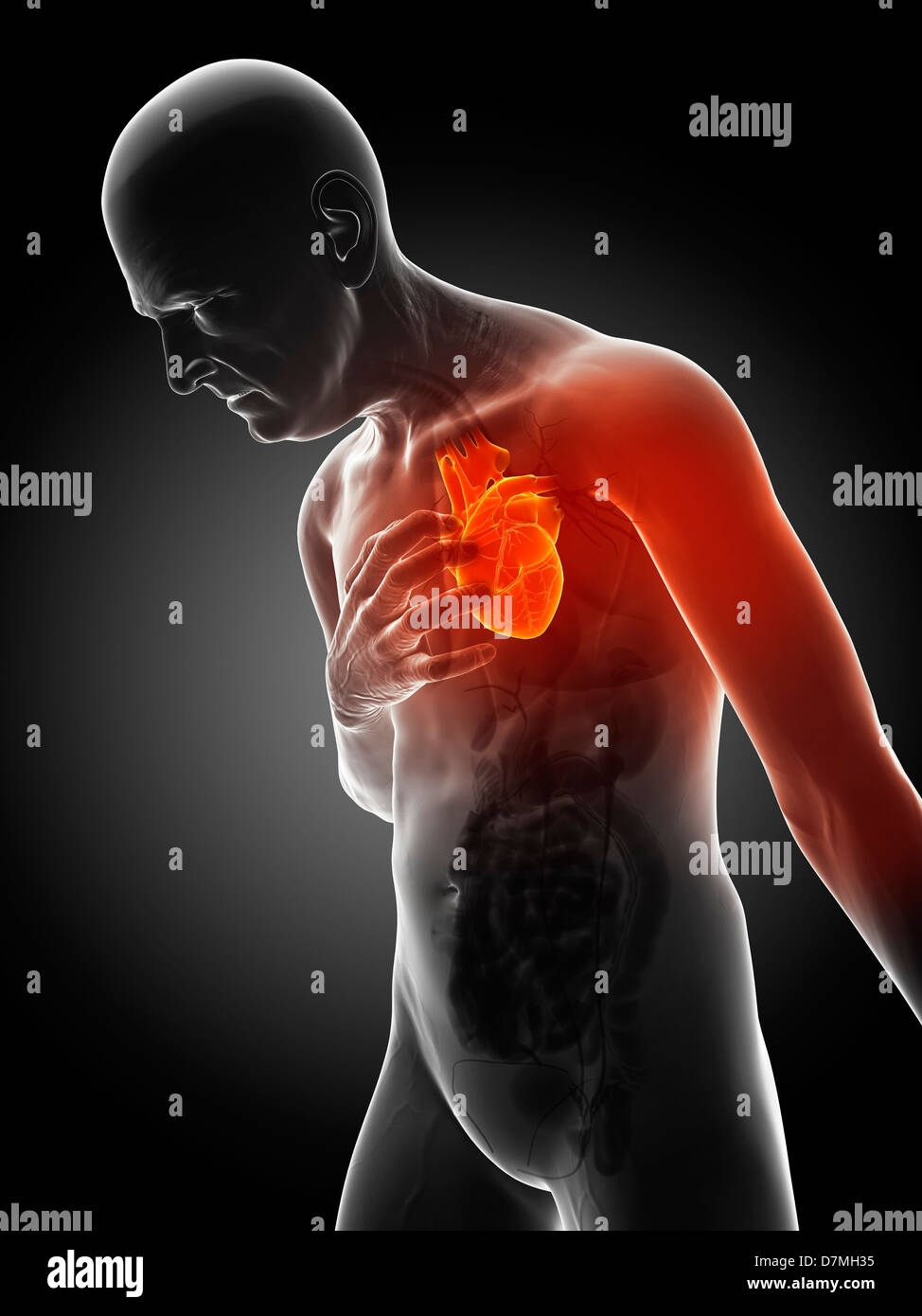 Heart attack, artwork Stock Photo - Alamy