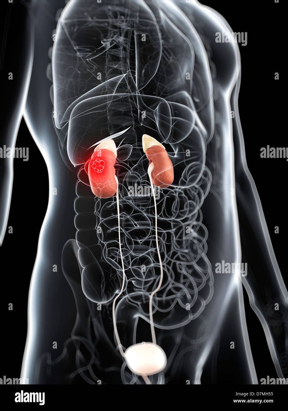 Male kidney cancer hi-res stock photography and images - Alamy