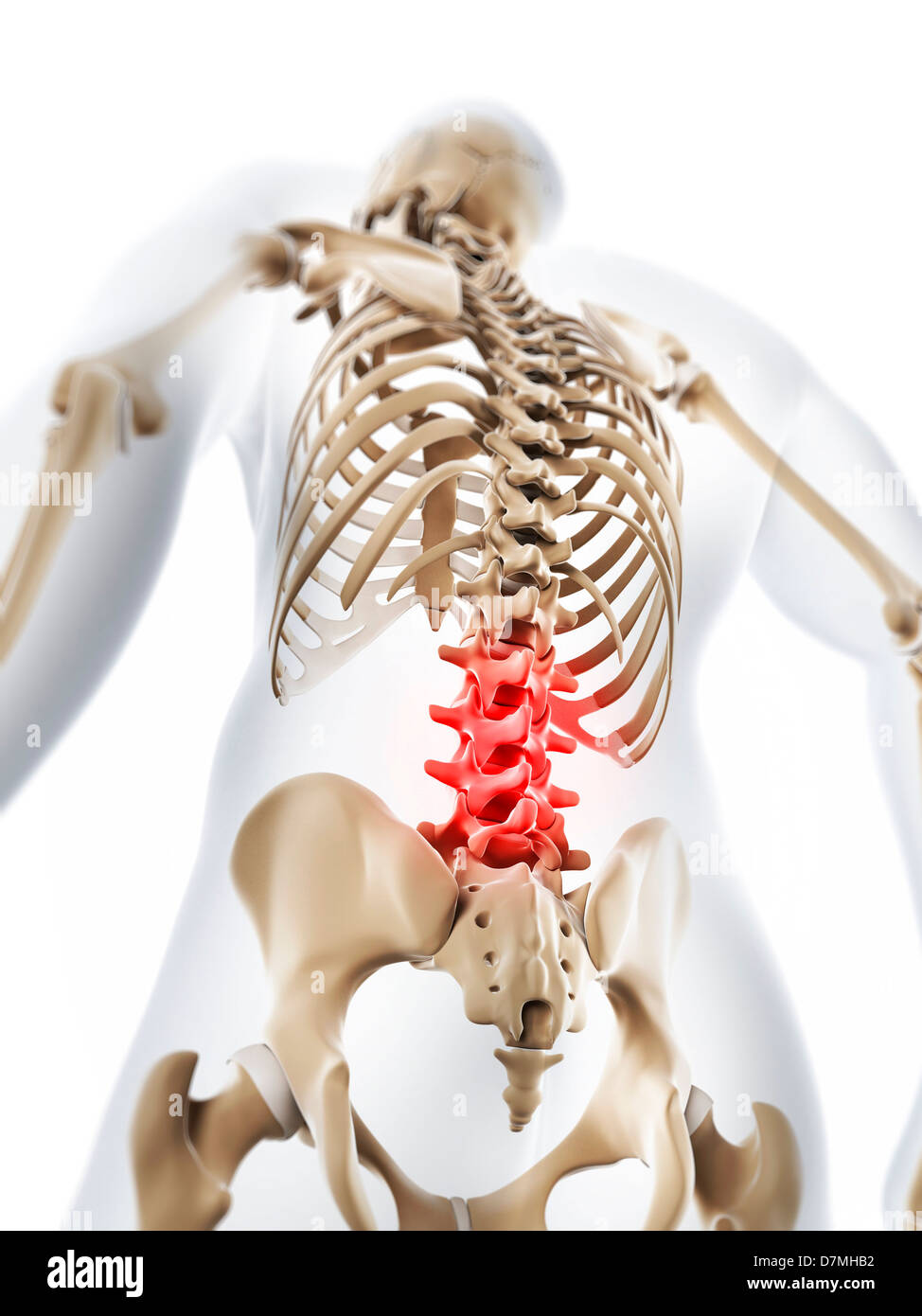 Lower back pain, conceptual artwork Stock Photo - Alamy