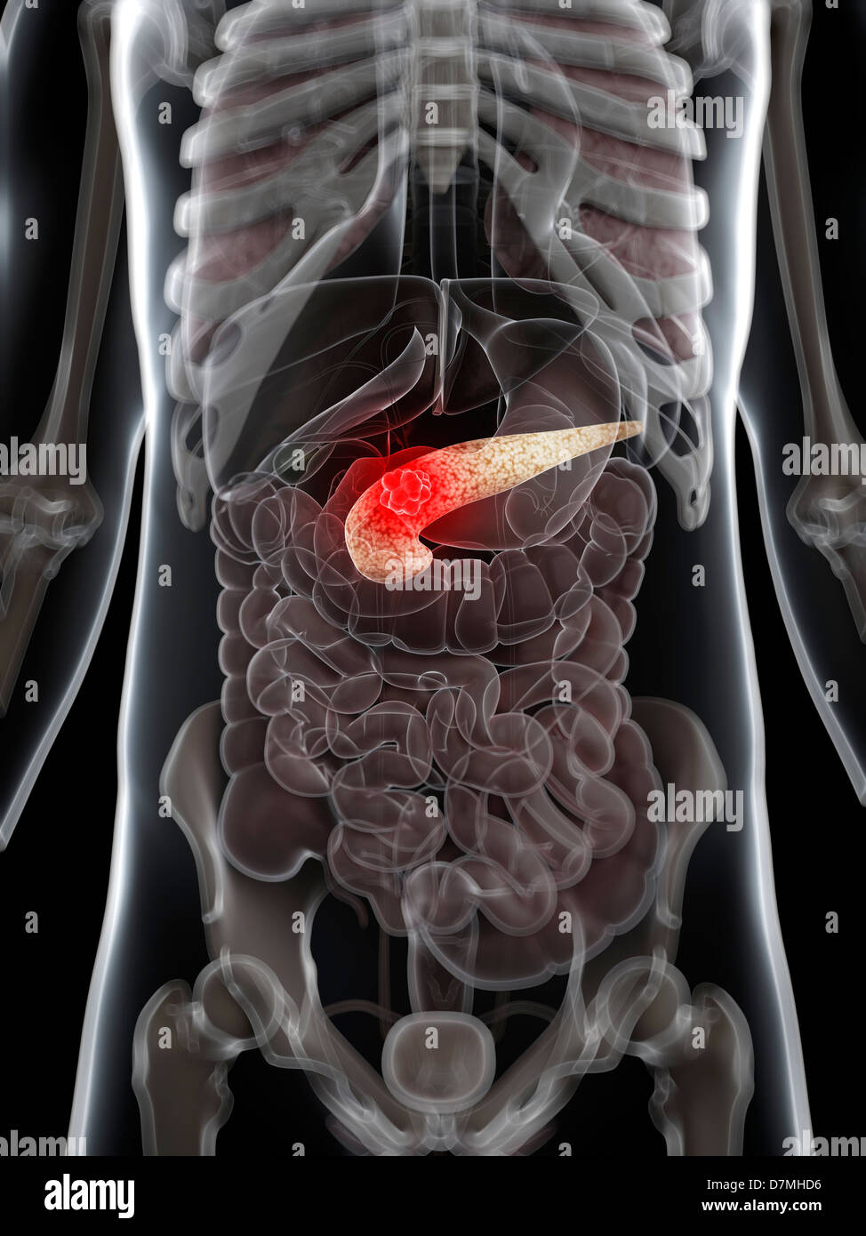 Pancreatic cancer hi-res stock photography and images - Alamy