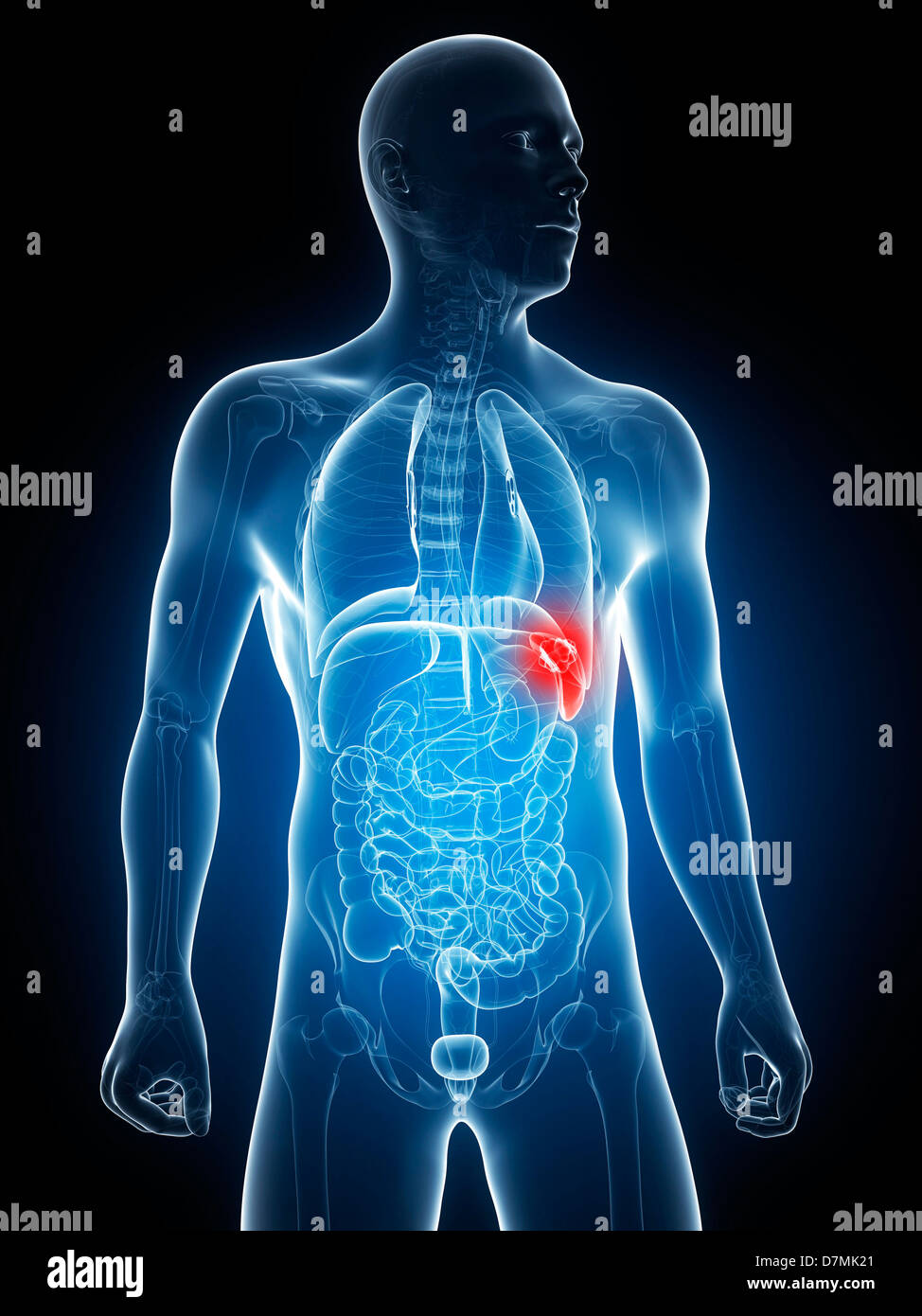 Spleen cancer, artwork Stock Photo - Alamy