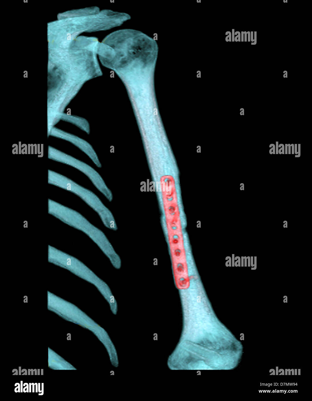 Rib fracture hi-res stock photography and images - Alamy