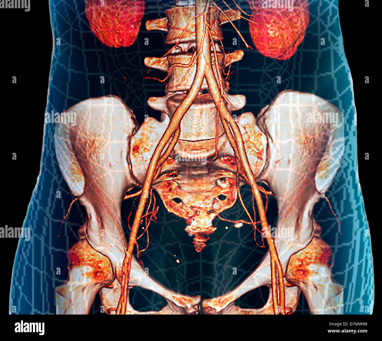 Abdominal aorta, 3D CT scan Stock Photo - Alamy