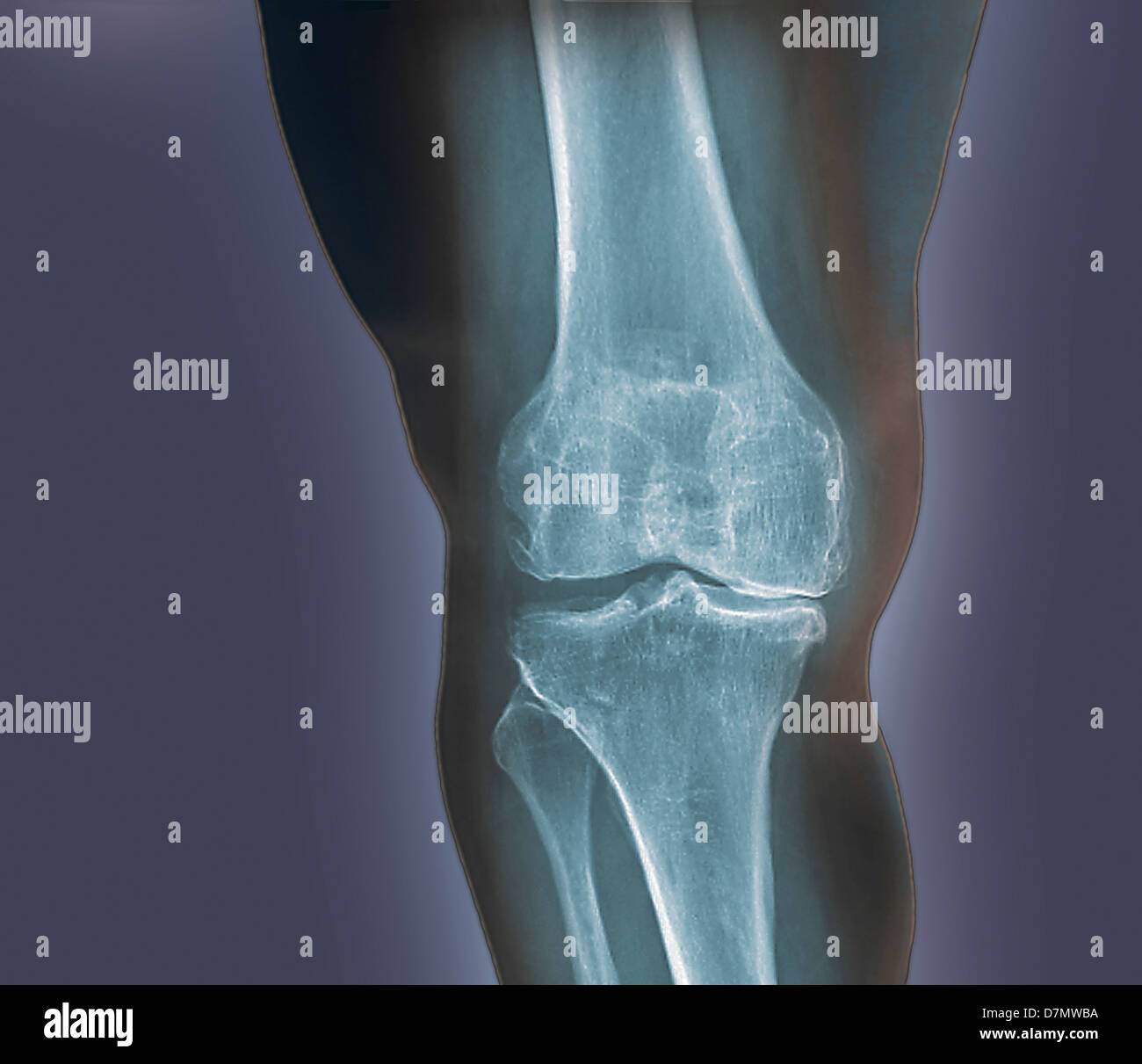 Arthritis of the knee, X-ray Stock Photo - Alamy