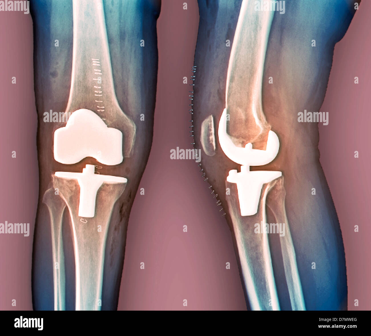 X ray of knee replacement hi-res stock photography and images - Alamy