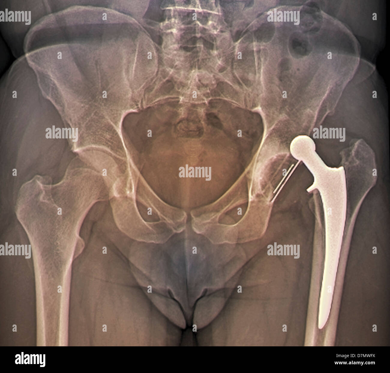 Dislocated hip replacement, X-ray Stock Photo - Alamy