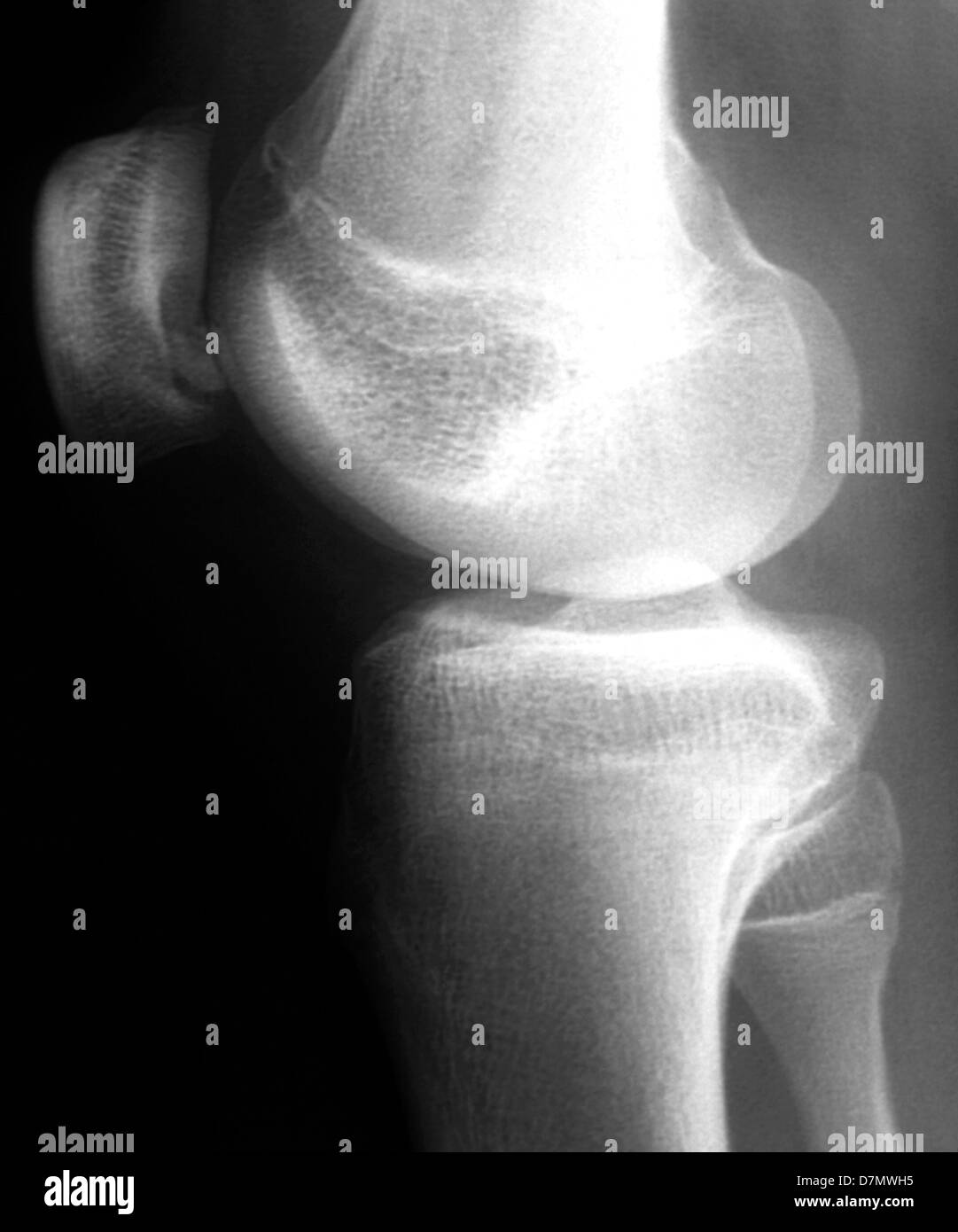 X Ray Of Knee High Resolution Stock Photography and Images - Alamy