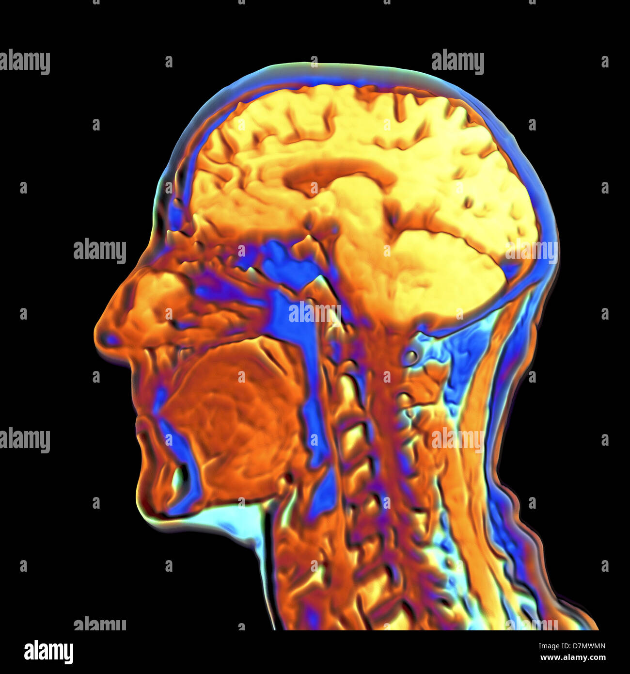 Coloured MRI scan of the human head Stock Photo - Alamy