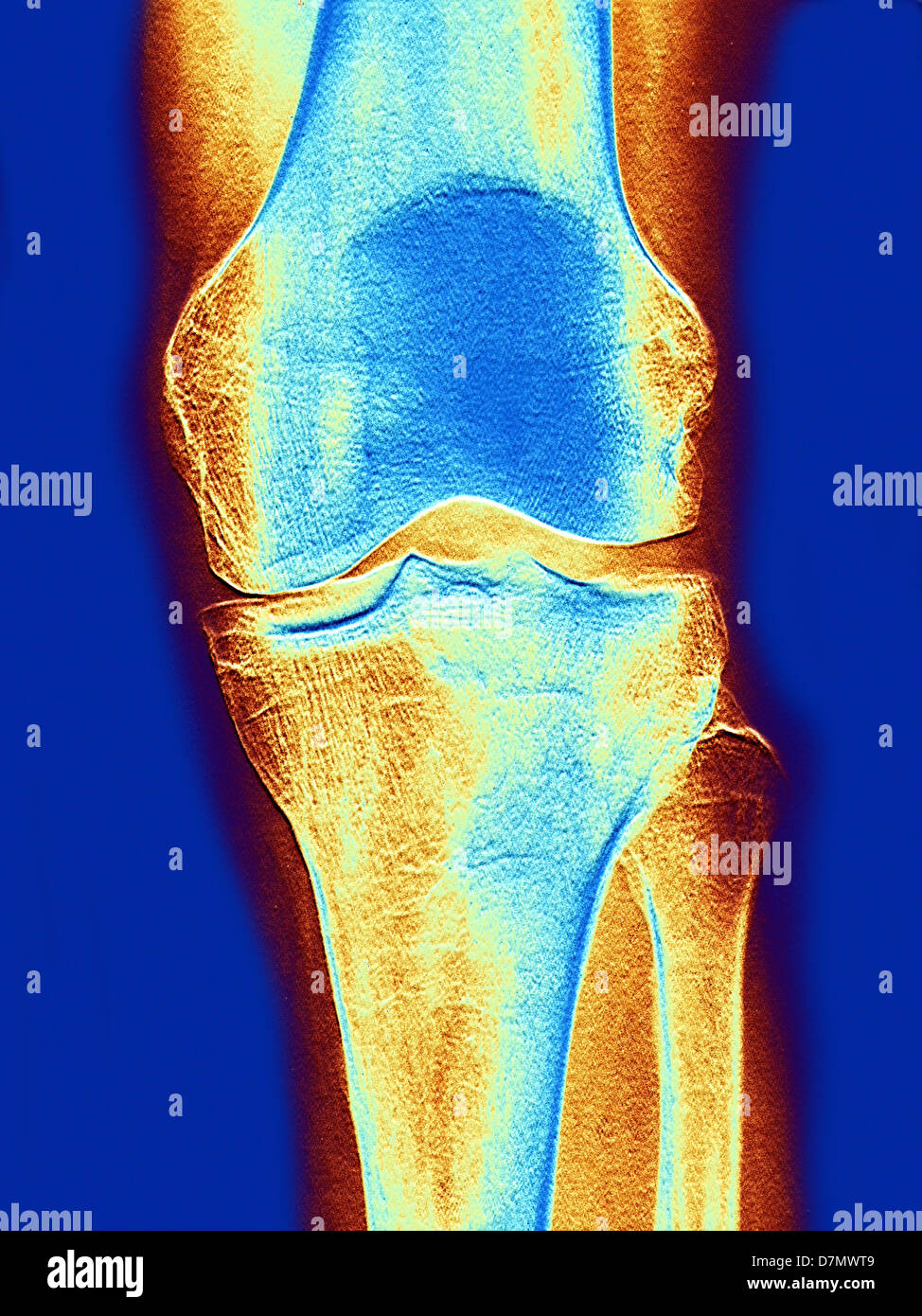 Normal knee x ray hi-res stock photography and images - Alamy