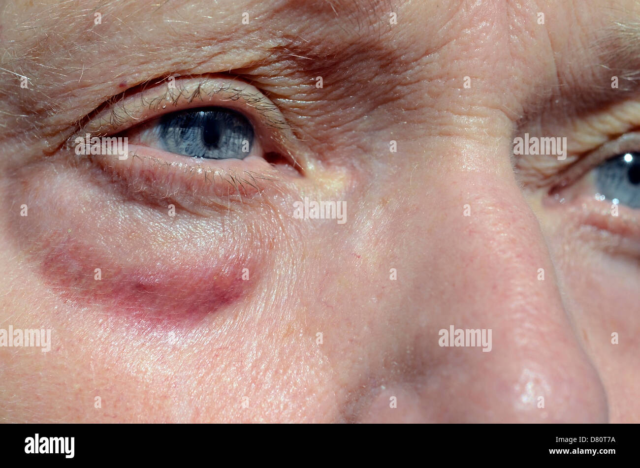 Closeup of a sore, injured, area below a woman's eye Stock Photo - Alamy