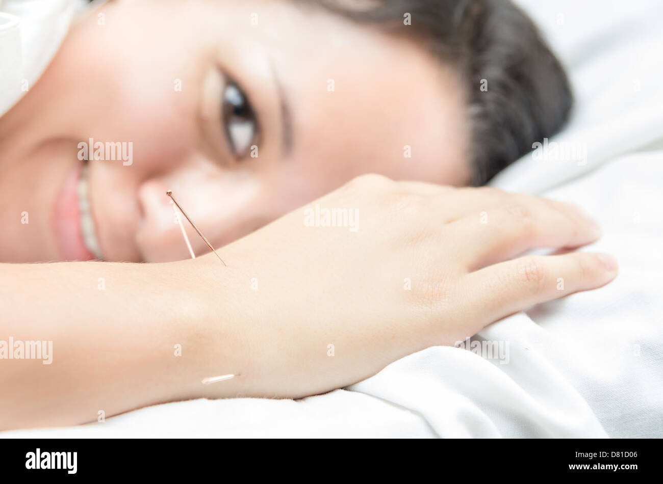 Acupuncture patient with needles along arm Stock Photo - Alamy