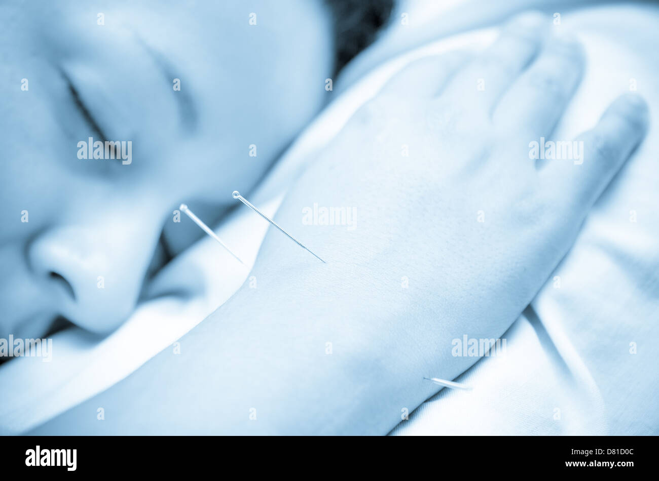 Acupuncture patient with needles along arm Stock Photo - Alamy