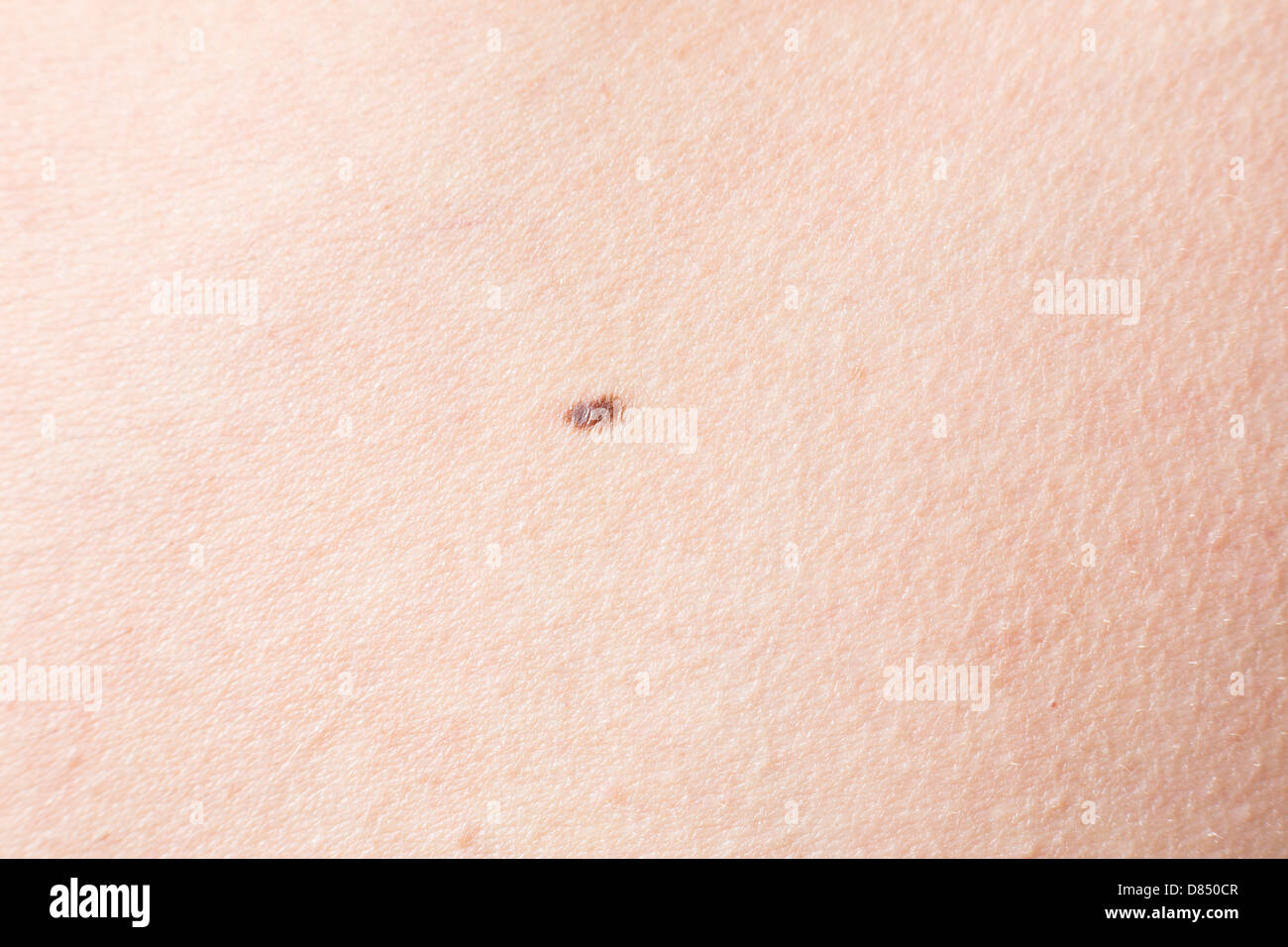 Skin Cancer Mole Stock Photos & Skin Cancer Mole Stock Images - Alamy