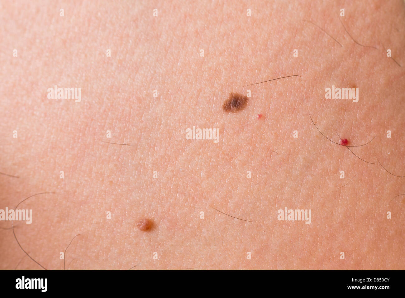 Skin Cancer Mole Stock Photos & Skin Cancer Mole Stock Images - Alamy