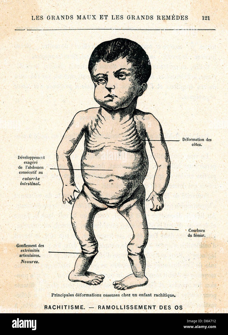 Rickets child hi-res stock photography and images - Alamy