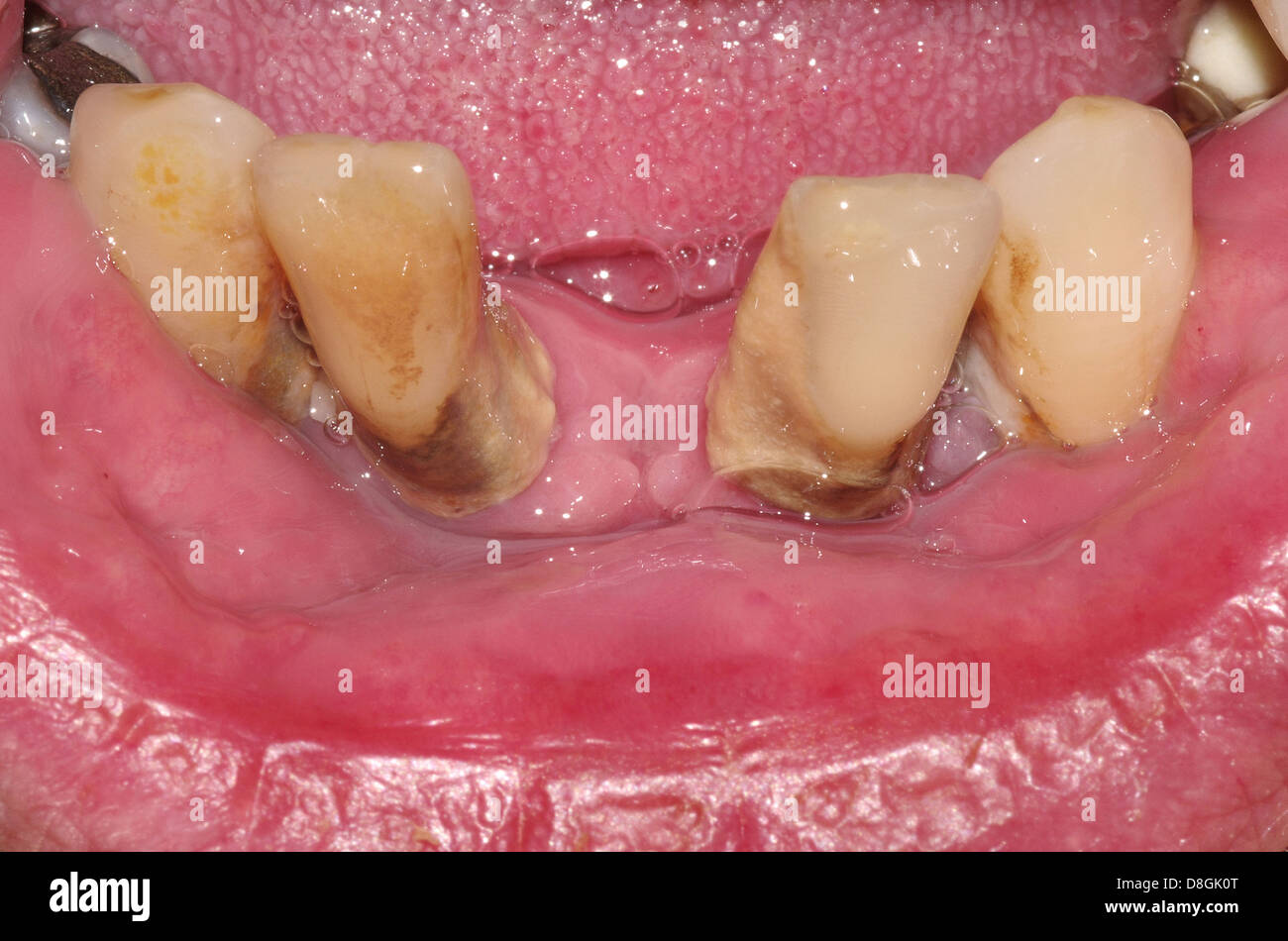 Entzuendliche parodontitis hi-res stock photography and images - Alamy