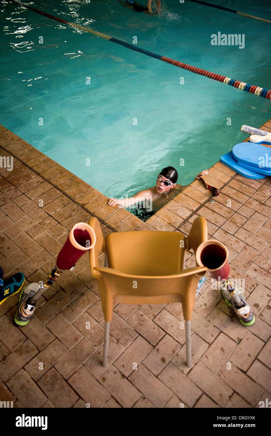 Deformed legs hi-res stock photography and images - Alamy