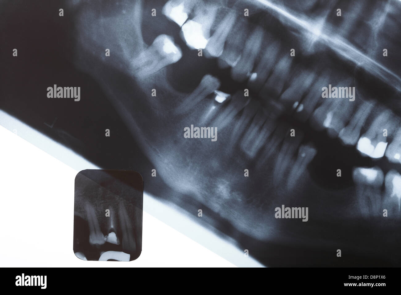 Panoramic and detail x-ray image scan of humans teeth Stock Photo - Alamy