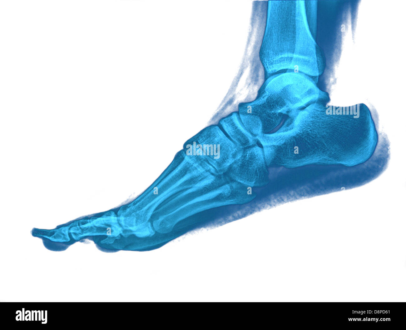 Foot xray image film bone x-ray roentgen Stock Photo - Alamy