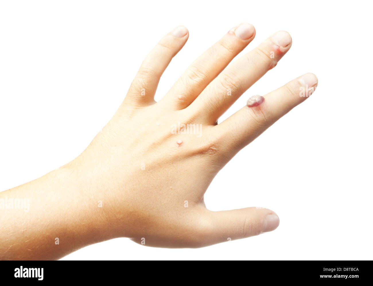 Wart hand hi-res stock photography and images - Alamy