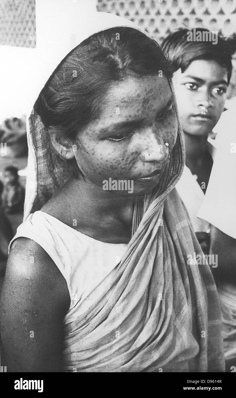 Historical smallpox hi-res stock photography and images - Alamy
