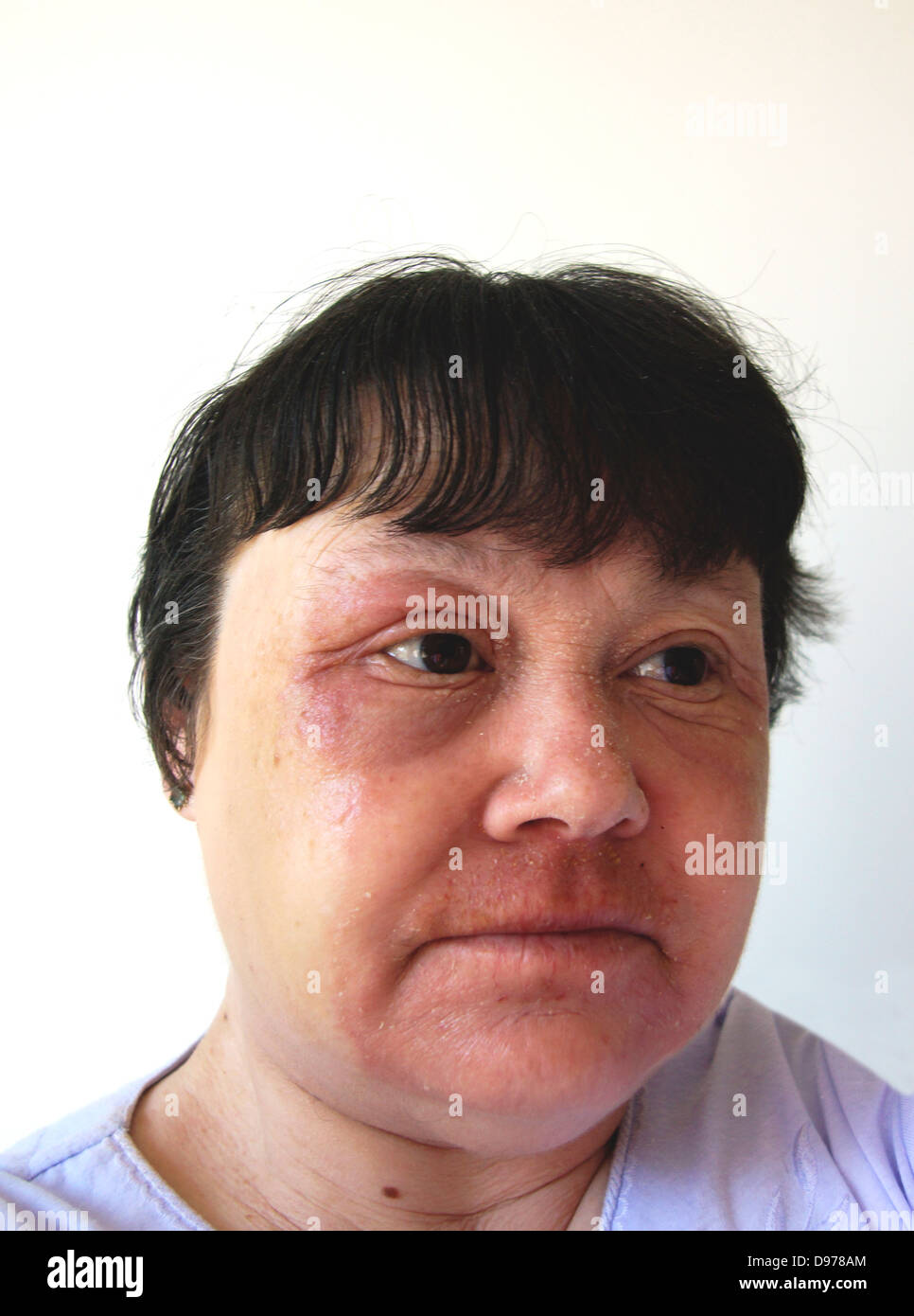 Woman suffering with eczema & a rash covering most of the face with the ...