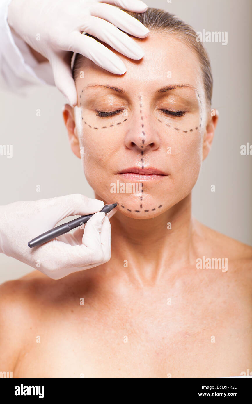 Woman plastic surgery face lines hi-res stock photography and images ...