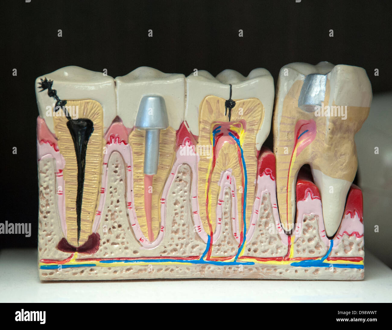 Common model of diseased teeth and gums used in medical and dental ...