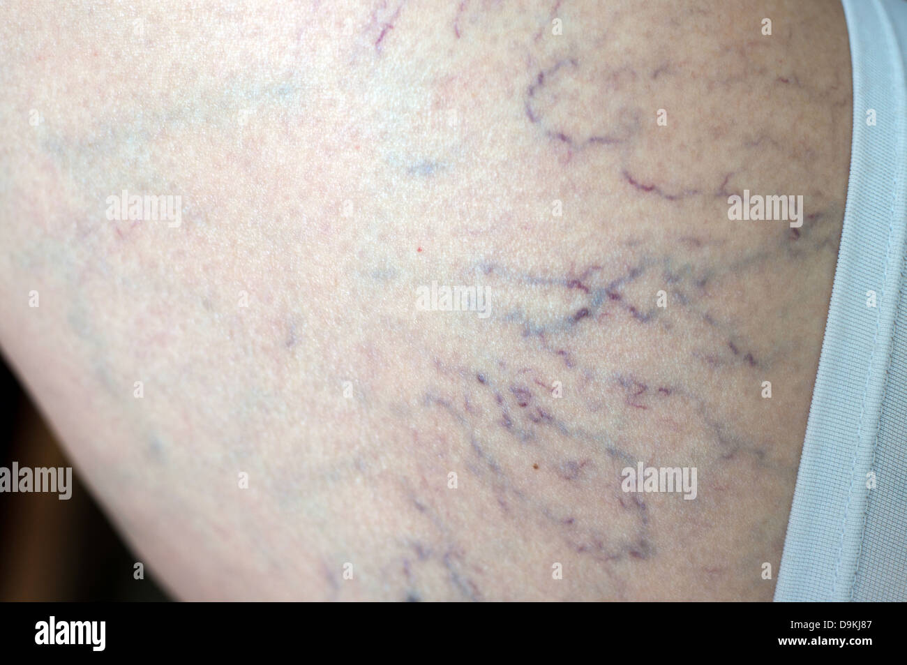 elderly woman with varicose veins Stock Photo - Alamy