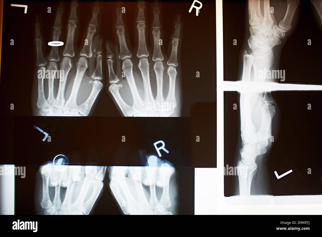 X ray image of bones in hand Stock Photo - Alamy