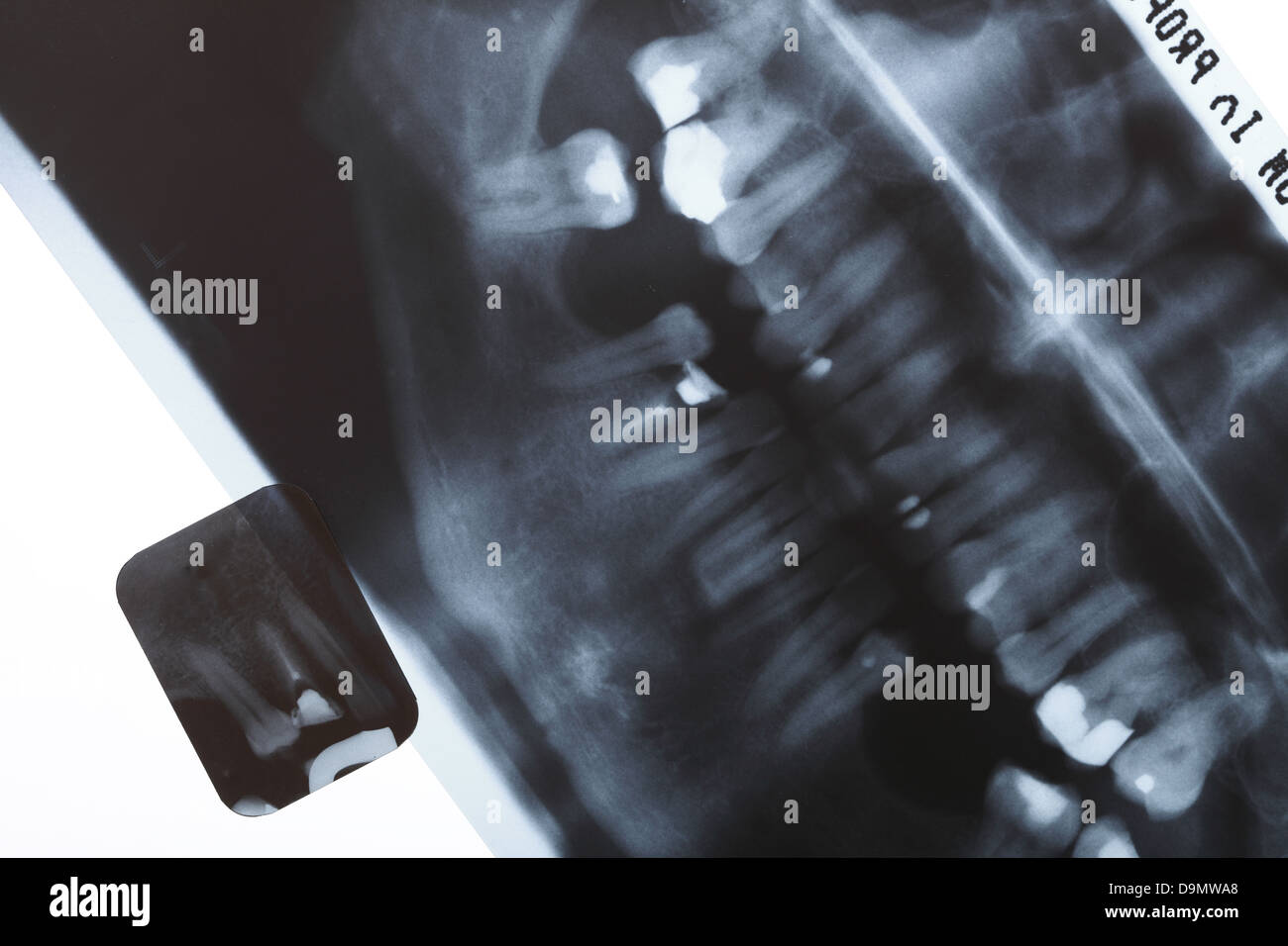 Panoramic and detail x-ray image scan of humans teeth Stock Photo - Alamy