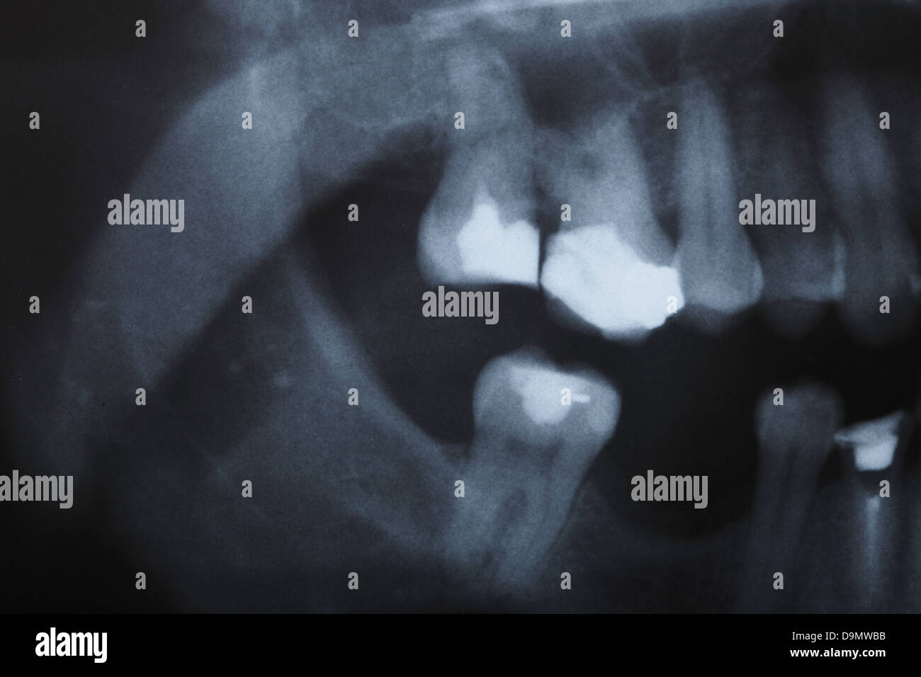 detail x-ray image scan of humans teeth Stock Photo - Alamy
