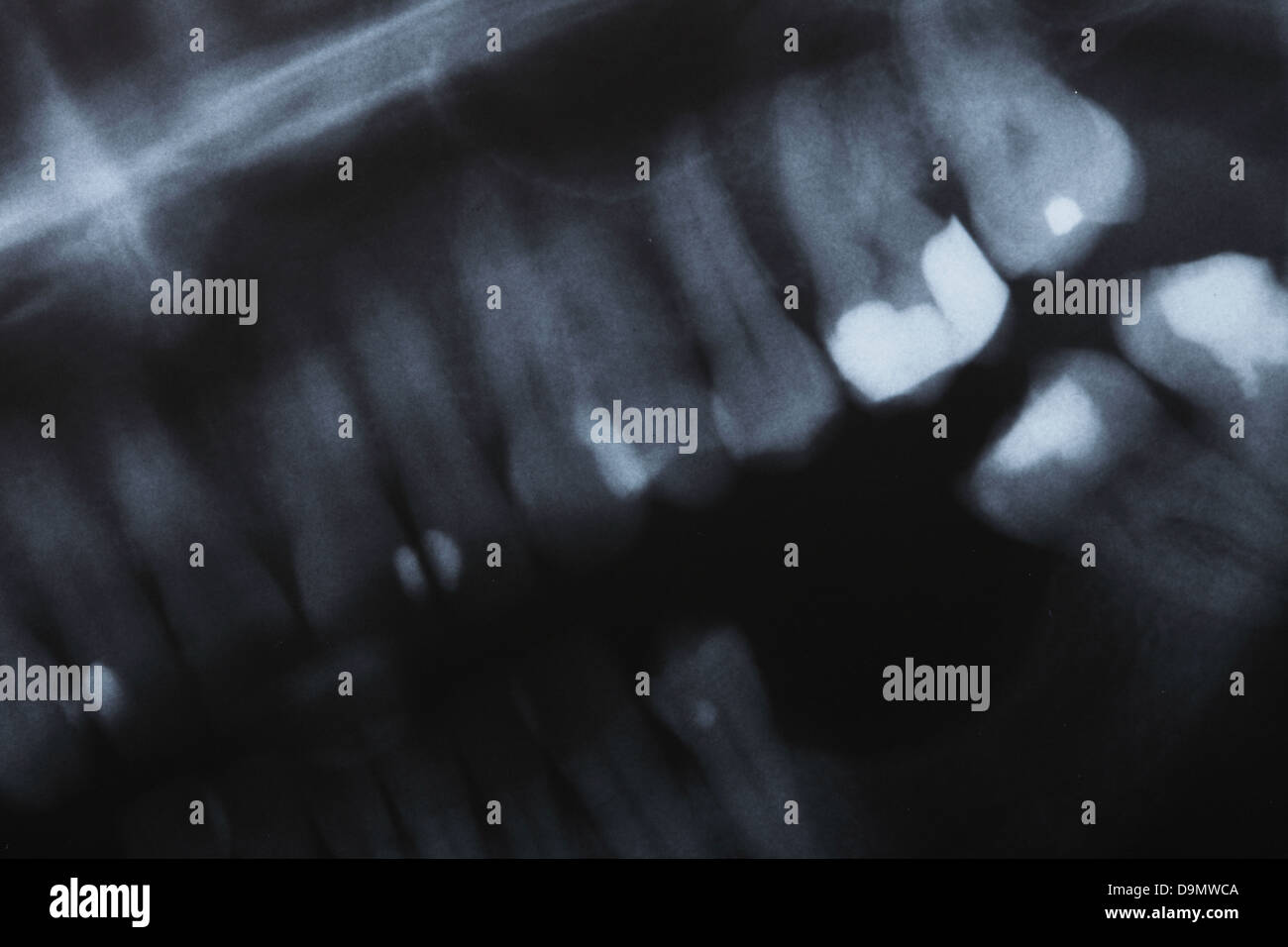 detail x-ray image scan of humans teeth Stock Photo - Alamy