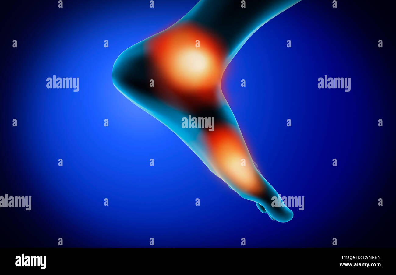 Foot injury hi-res stock photography and images - Alamy