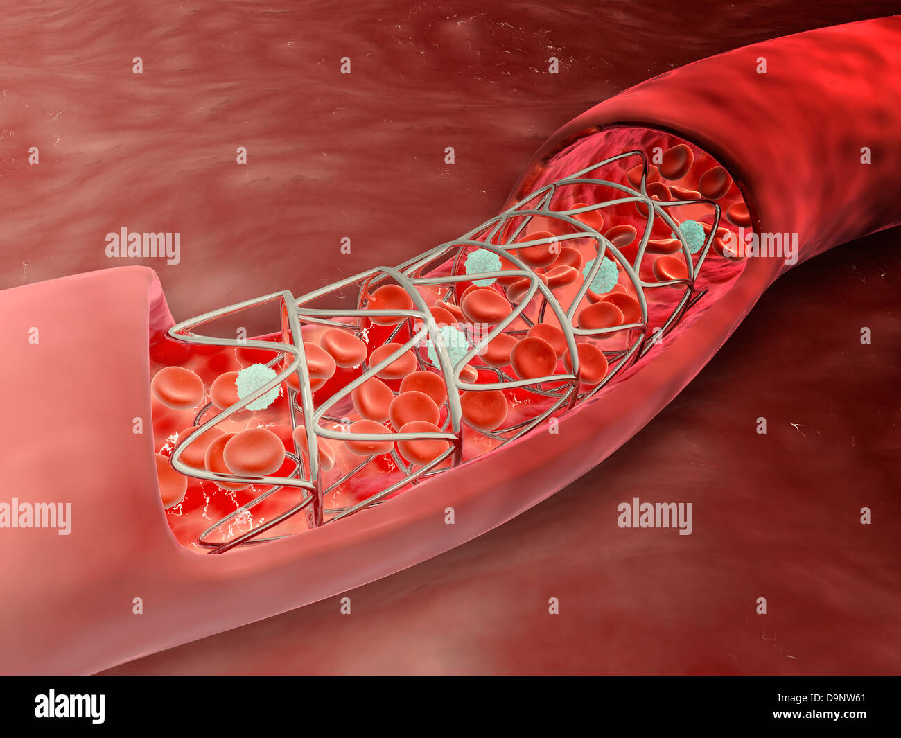 Microscopic view of an artery cross-section with blood flow and stent ...