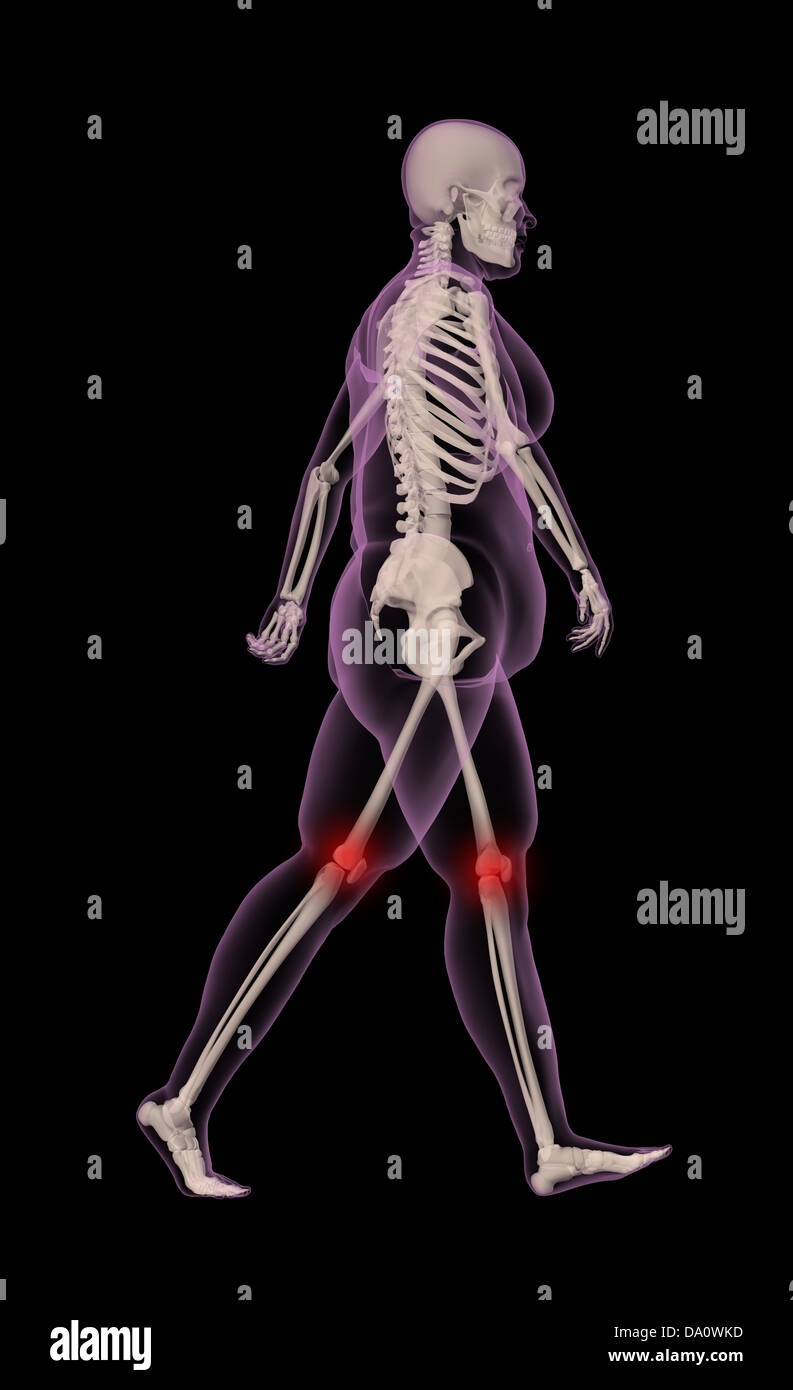 3D render of an overweight female medical skeleton walking with knee ...
