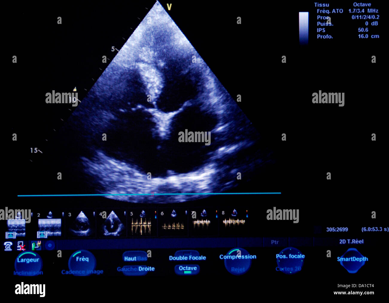 HEART, SONOGRAPHY RESULT Stock Photo - Alamy