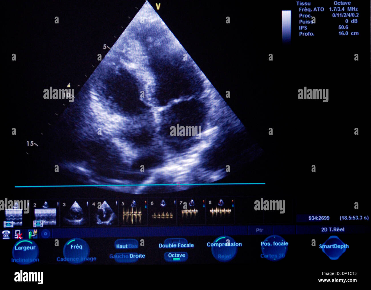 HEART, SONOGRAPHY RESULT Stock Photo - Alamy