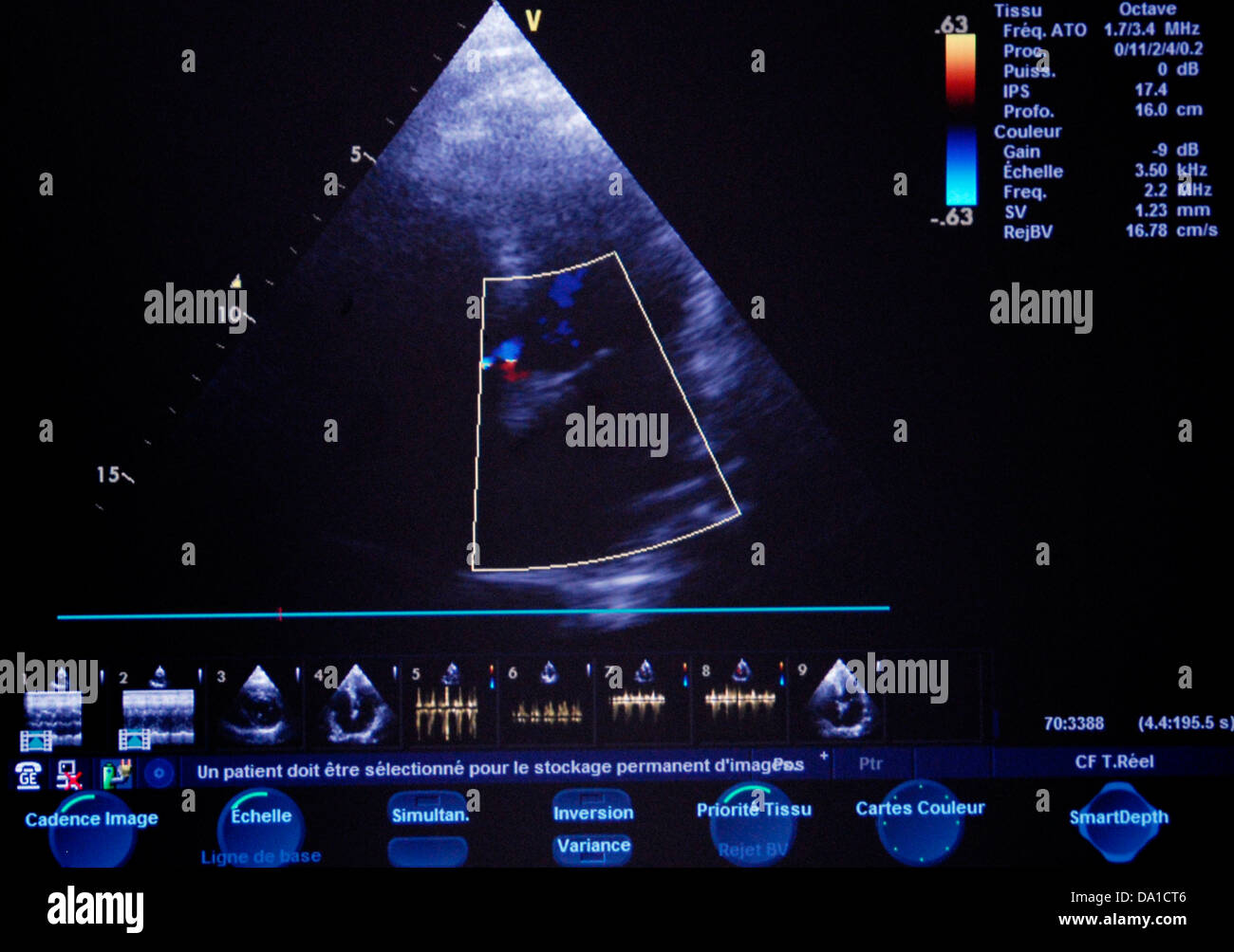 HEART, SONOGRAPHY RESULT Stock Photo - Alamy