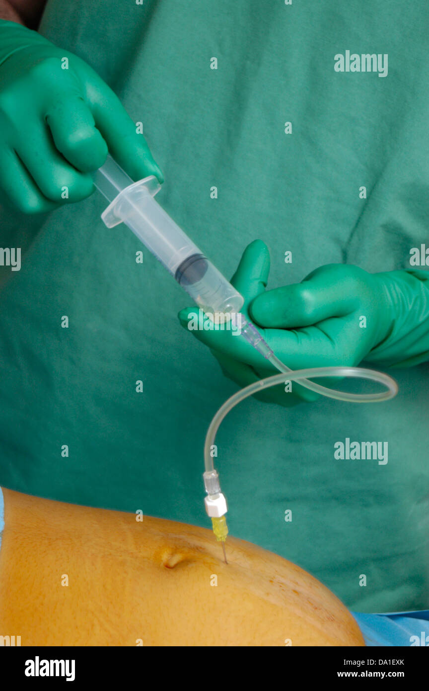 Amniocentesis hi-res stock photography and images - Alamy