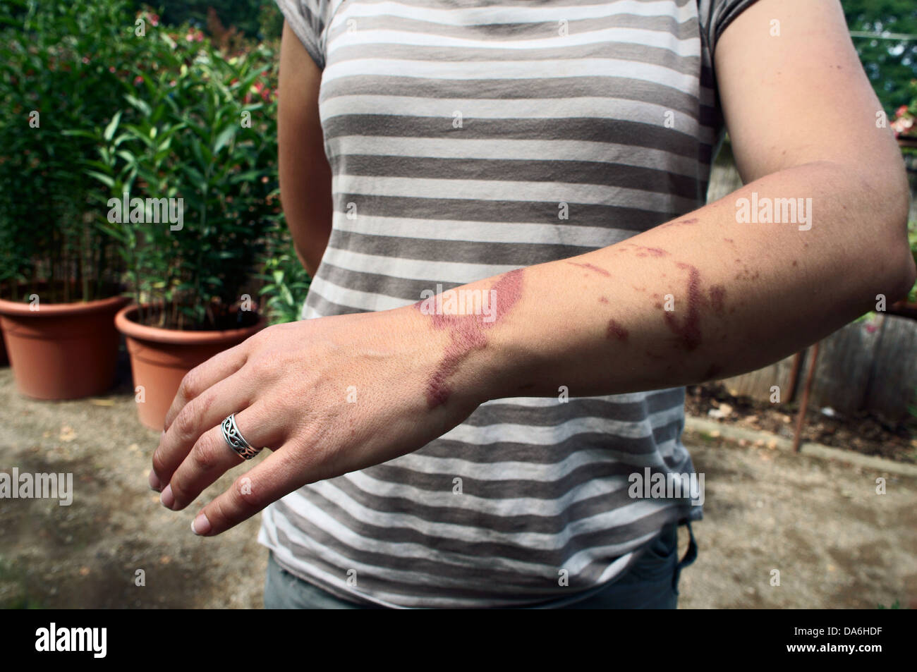 Injury scar hi-res stock photography and images - Alamy