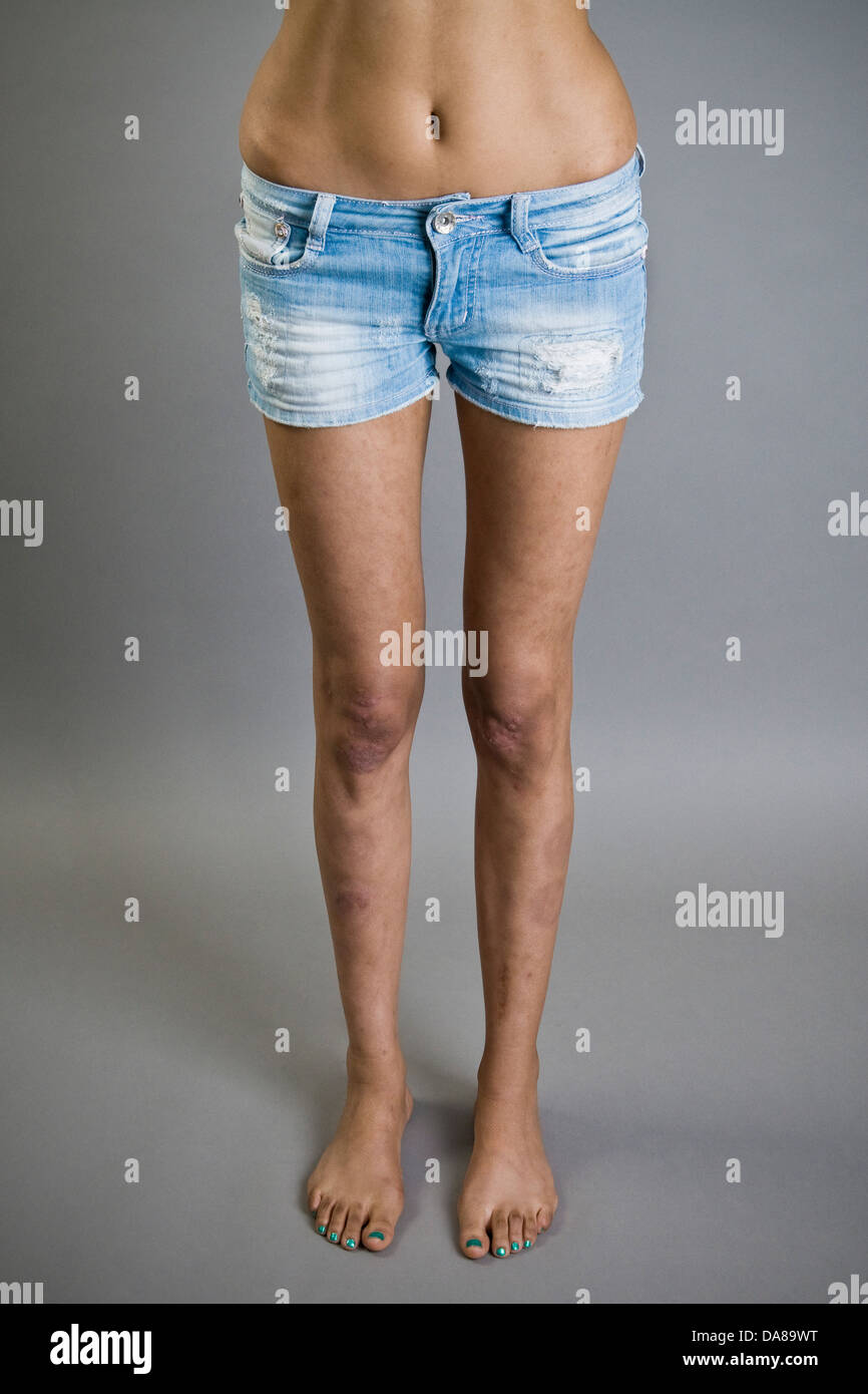 Thin woman anorexia hi-res stock photography and images - Alamy
