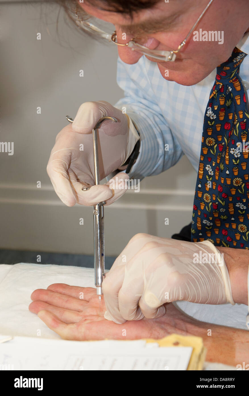 Dupuytrens contracture hand surgery hi-res stock photography and images ...