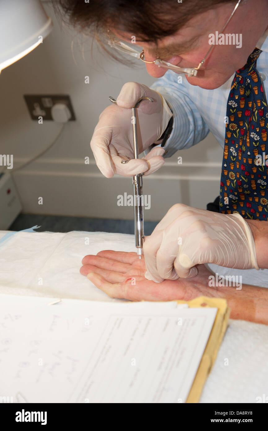 Dupuytren's contracture treatment of the little finger on a woman's ...